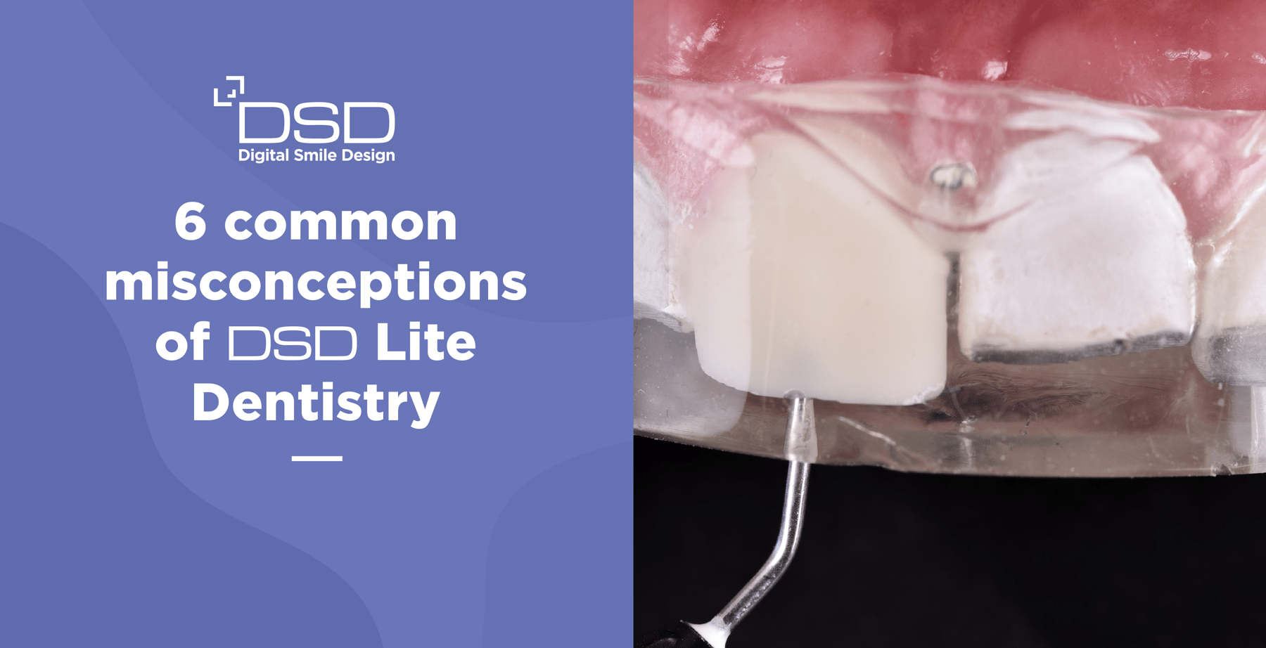 6 common misconceptions of DSD Lite Dentistry resolved