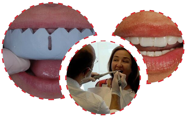 6 Smile Design Cases